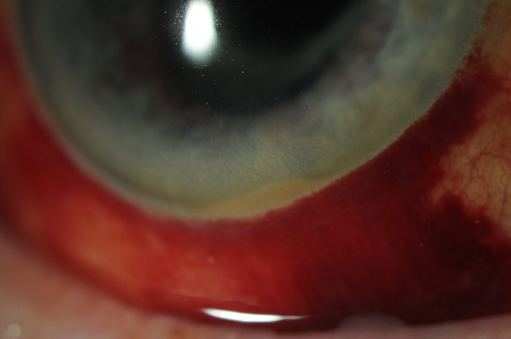 Ocular Emergencies and the Eye Safety Card – OPTOMETRY EVOLUTION