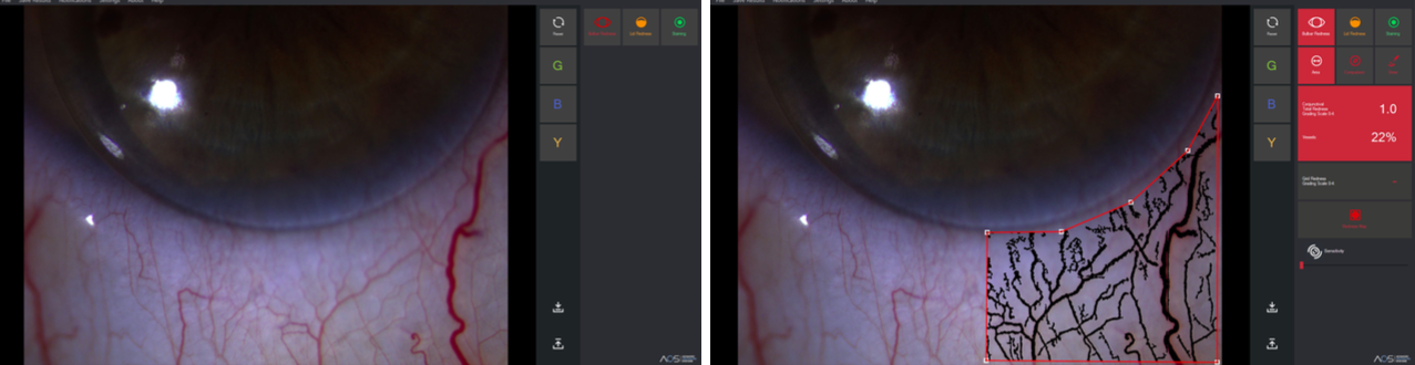 Innovative Anterior Grading System – the Latest Great Advance in Ocular ...