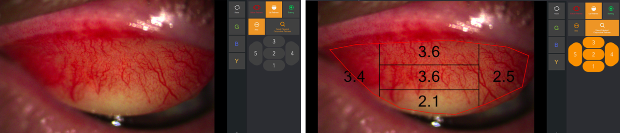 Innovative Anterior Grading System – the Latest Great Advance in Ocular ...