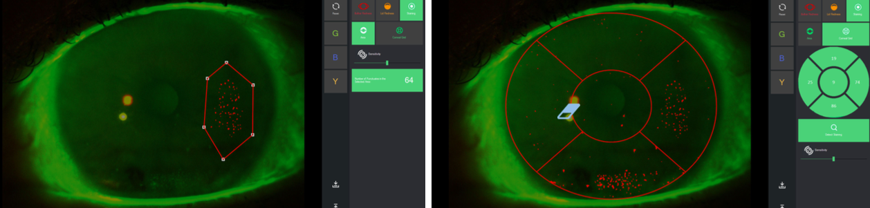 Innovative Anterior Grading System – the Latest Great Advance in Ocular ...