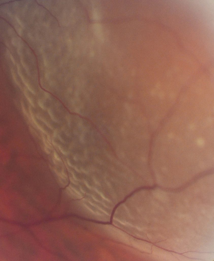 Sudden Loss of Vision – OPTOMETRY EVOLUTION