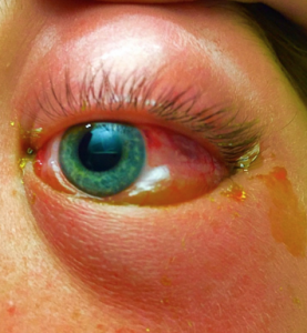 Mastering Emergency Eye Care: Essential Triage Guidelines for Eye ...