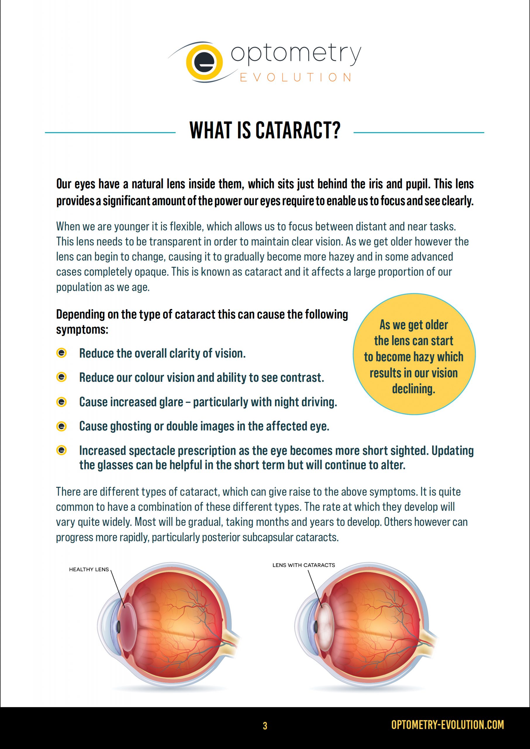 Cataract Treatment Guide – OPTOMETRY EVOLUTION